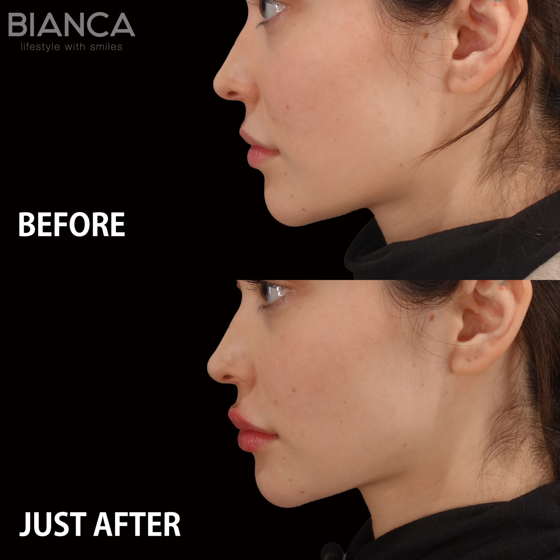Natural beauty enhancements with injectables: Real case highlights ...