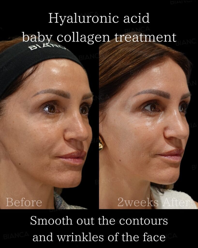 Cheek Fillers and Female Wellness | BIANCA in Tokyo, Japan