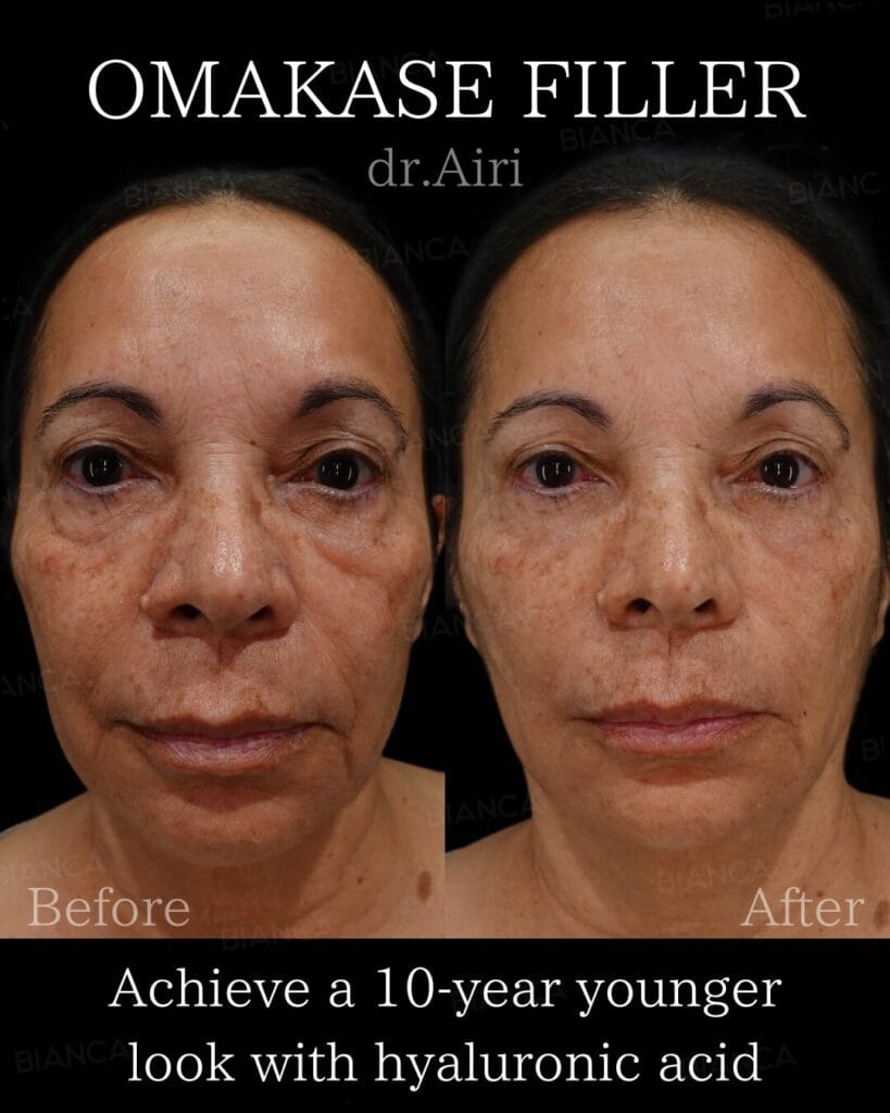 Non-Surgical Face Lift Guide: Thread Lift and Hyaluronic Acid in Tokyo ...