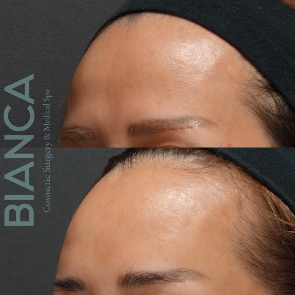 Fillers Voluma: Presenting The Latest Treatments in Aesthetic Surgery ...